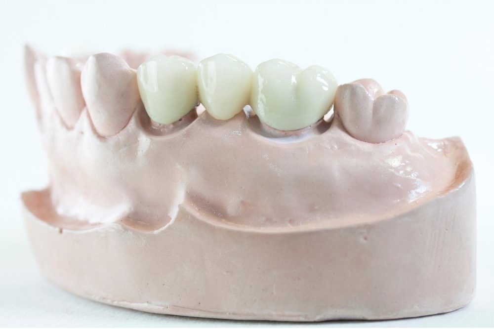 What’s the difference between crowns and onlay? | Dentist in Croydon